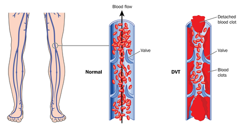 Peripheral Vascular Disease & The Feet | Dubai Podiatry Centre