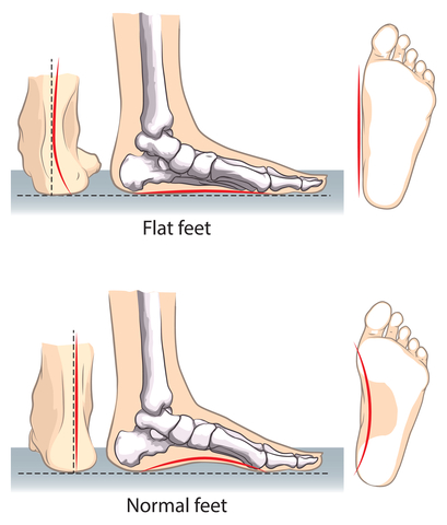 Get Foot Arches | Dubai Podiatry Centre