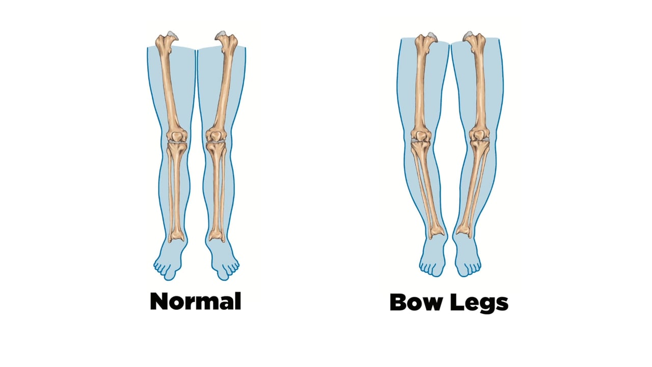 Genu Varum (Bowed Legs) جينو فاروم (تقوس الساقين) | Dubai Podiatry Centre
