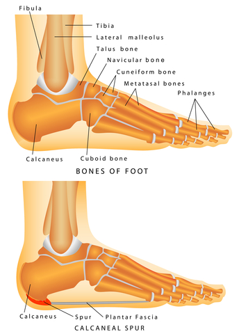 Heel bone fractures كسور عظام الكعب – Dubai Podiatry Centre