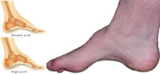 Pes Cavus - High Arches | Dubai Podiatry Centre