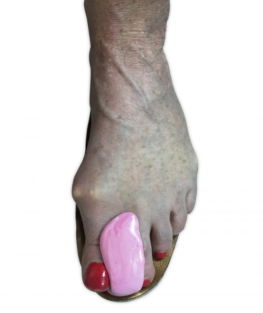 Hallux Valgus وتسمى الحالة إبهام القدم الأروح | Dubai Podiatry Centre