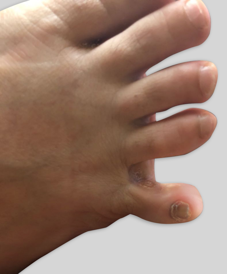 toe corn | Dubai Podiatry Centre