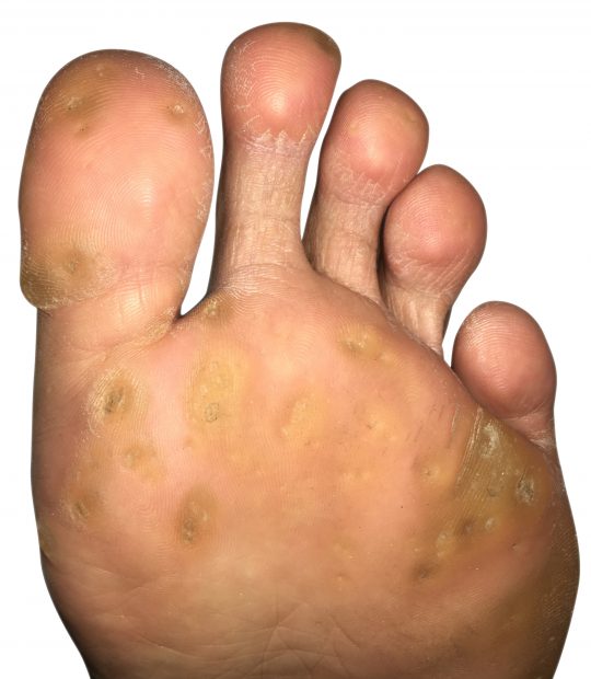 Dubai Podiatry - Seed corns (2) | Dubai Podiatry Centre