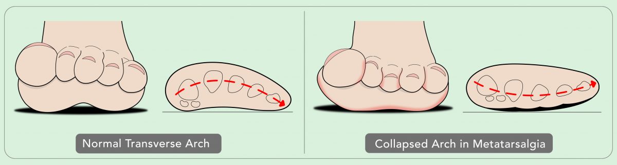 collapsed and normal | Dubai Podiatry Centre