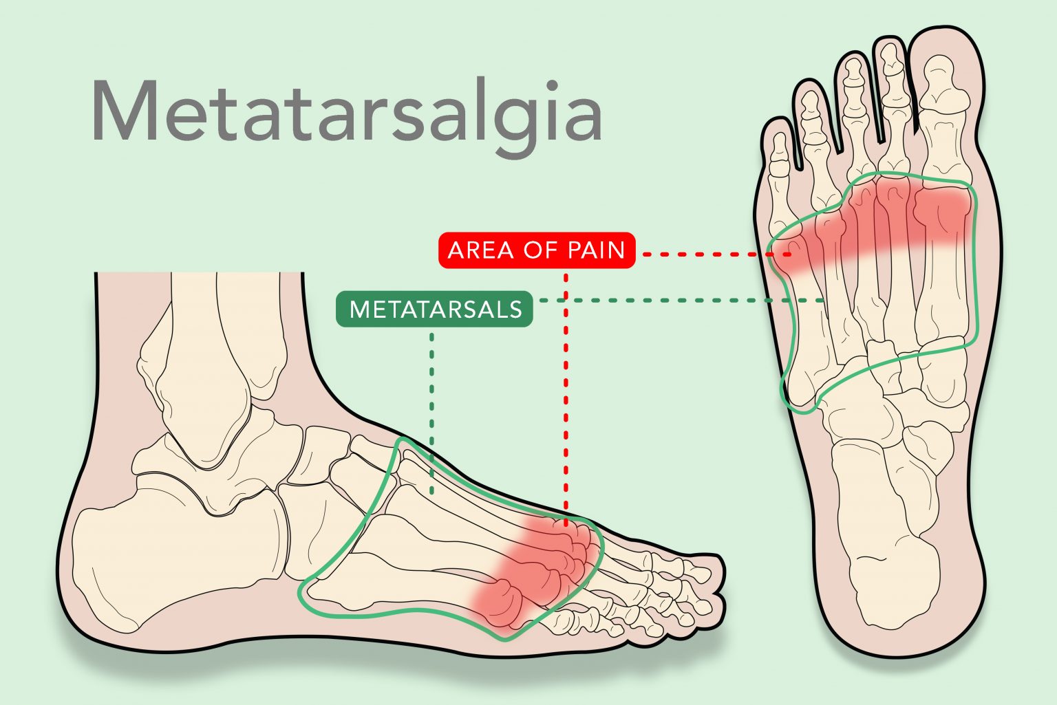 Metatarsalgia Drawing | Dubai Podiatry Centre