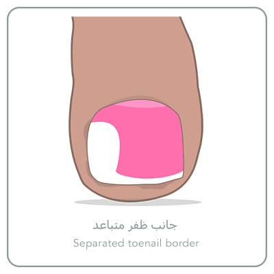 Different types of Toenails | Dubai Podiatry Centre