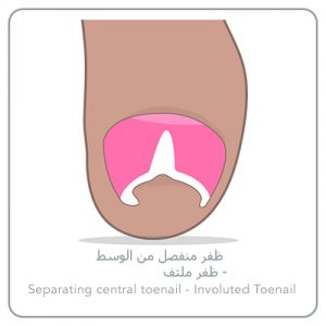 Different types of Toenails | Dubai Podiatry Centre