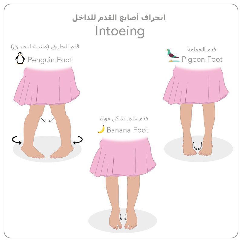 Intoeing for more | Dubai Podiatry Centre