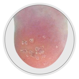 Heel Mosaic Verruca كعب فسيفساء ثؤلول | Dubai Podiatry Centre
