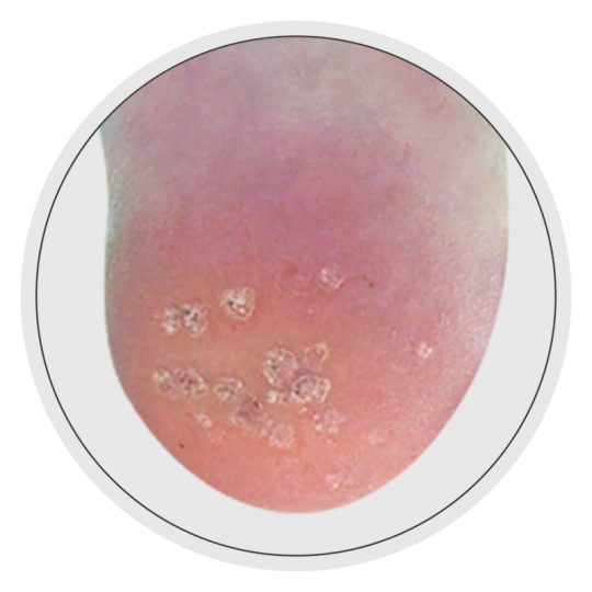 Heel Mosaic Verruca كعب فسيفساء ثؤلول | Dubai Podiatry Centre