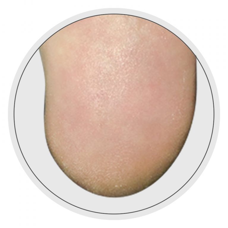 Heel Mosaic Verruca كعب فسيفساء ثؤلول | Dubai Podiatry Centre