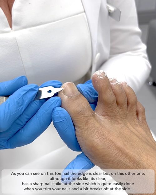Nail Spike FC | Dubai Podiatry Centre