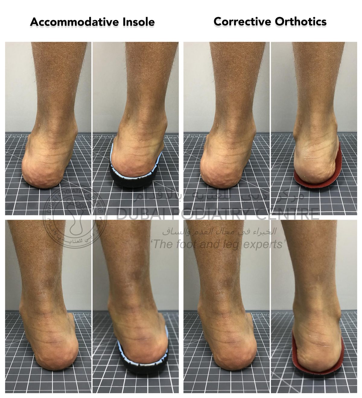 Difference between an Accommodative Insole and a Corrective Orthotic ...