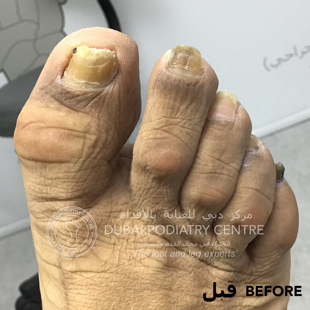MP_Before and After_Layout 1_before | Dubai Podiatry Centre
