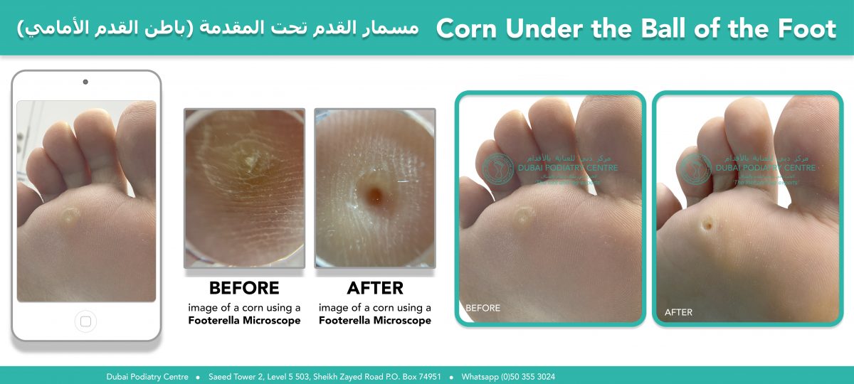 Why Does a Corn Keep Coming Back Under the Ball of the Foot? – Dubai ...