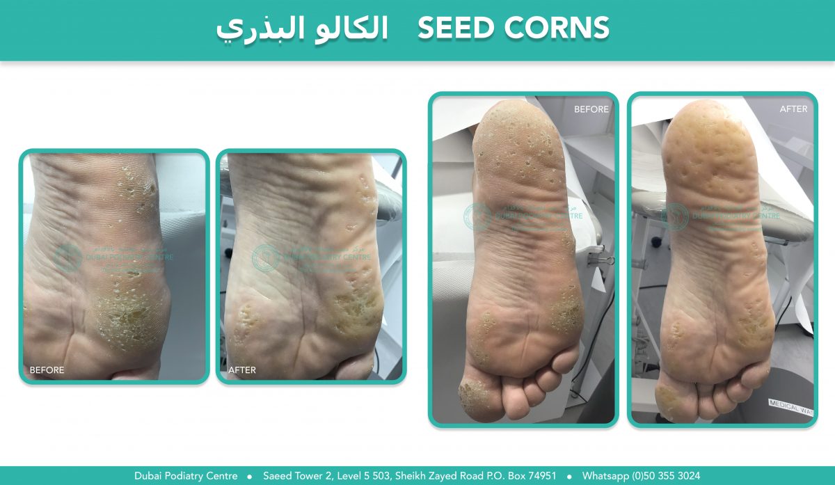 WhatsApp Image Blog_Foot Corns_Seed Corns | Dubai Podiatry Centre