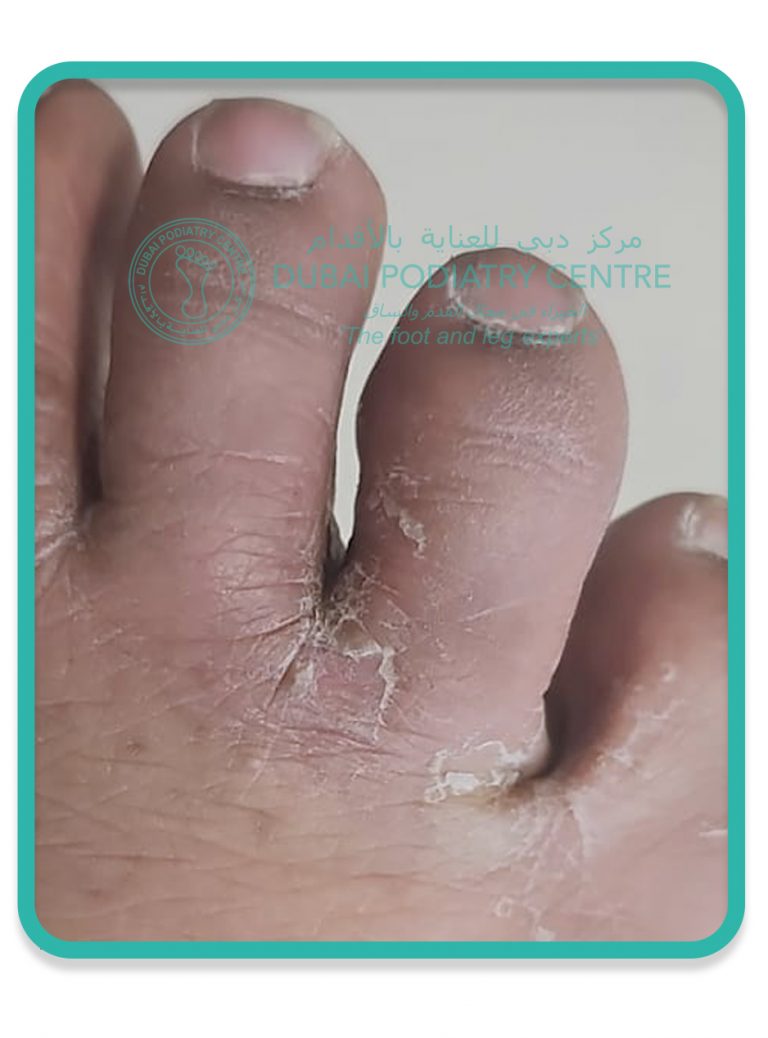 Fungal Infection Between the Toes | Dubai Podiatry Centre