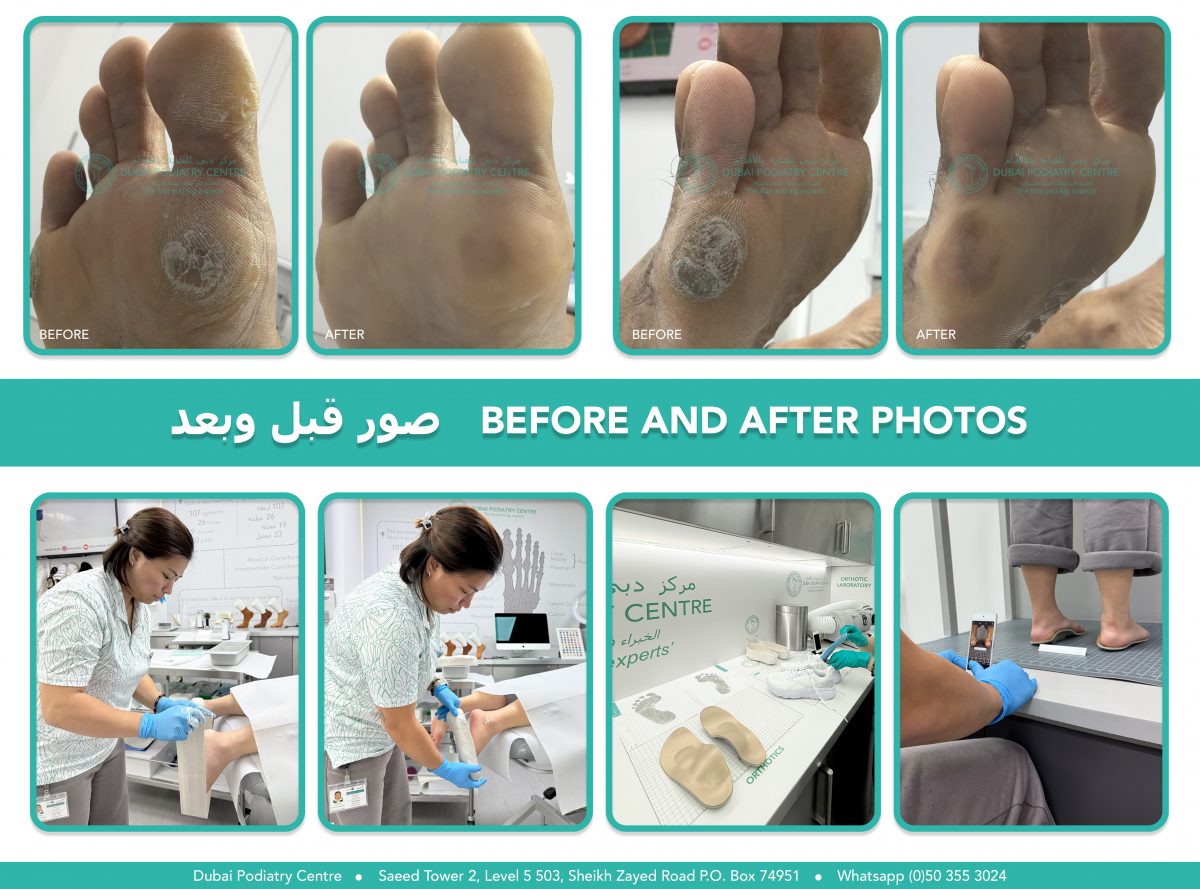 How to Stop Foot Calluses from Coming Back | Dubai Podiatry Centre